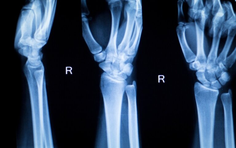 De Quervain’s Tenosynovitis Treatment In San Jose | Dr Mehta
