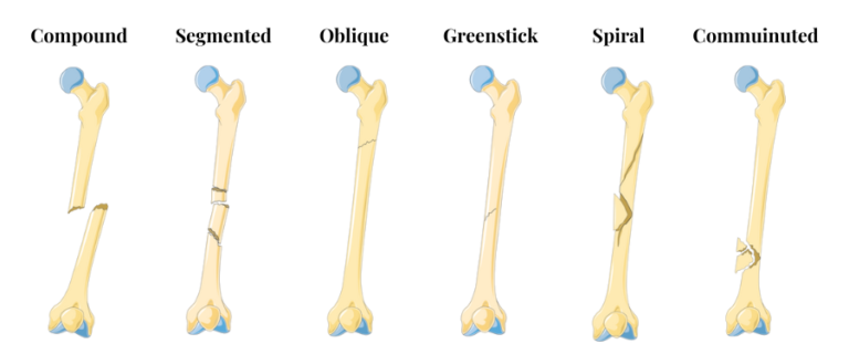 Orthopedic & Fracture Clinic In San Jose | Dr. Pamela Mehta