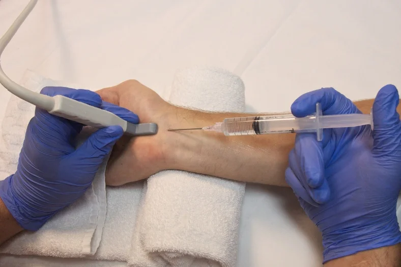 Carpal Tunnel Syndrome | Resilience Orthopedics, San Jose