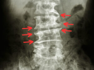 Expert Bone Spur Removal Surgery | Dr. Pamela Mehta | San Jose & Los Gatos