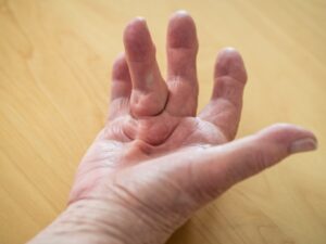 Dupuytren’s Contracture Vs Trigger Finger | Dr. Pamela Mehta