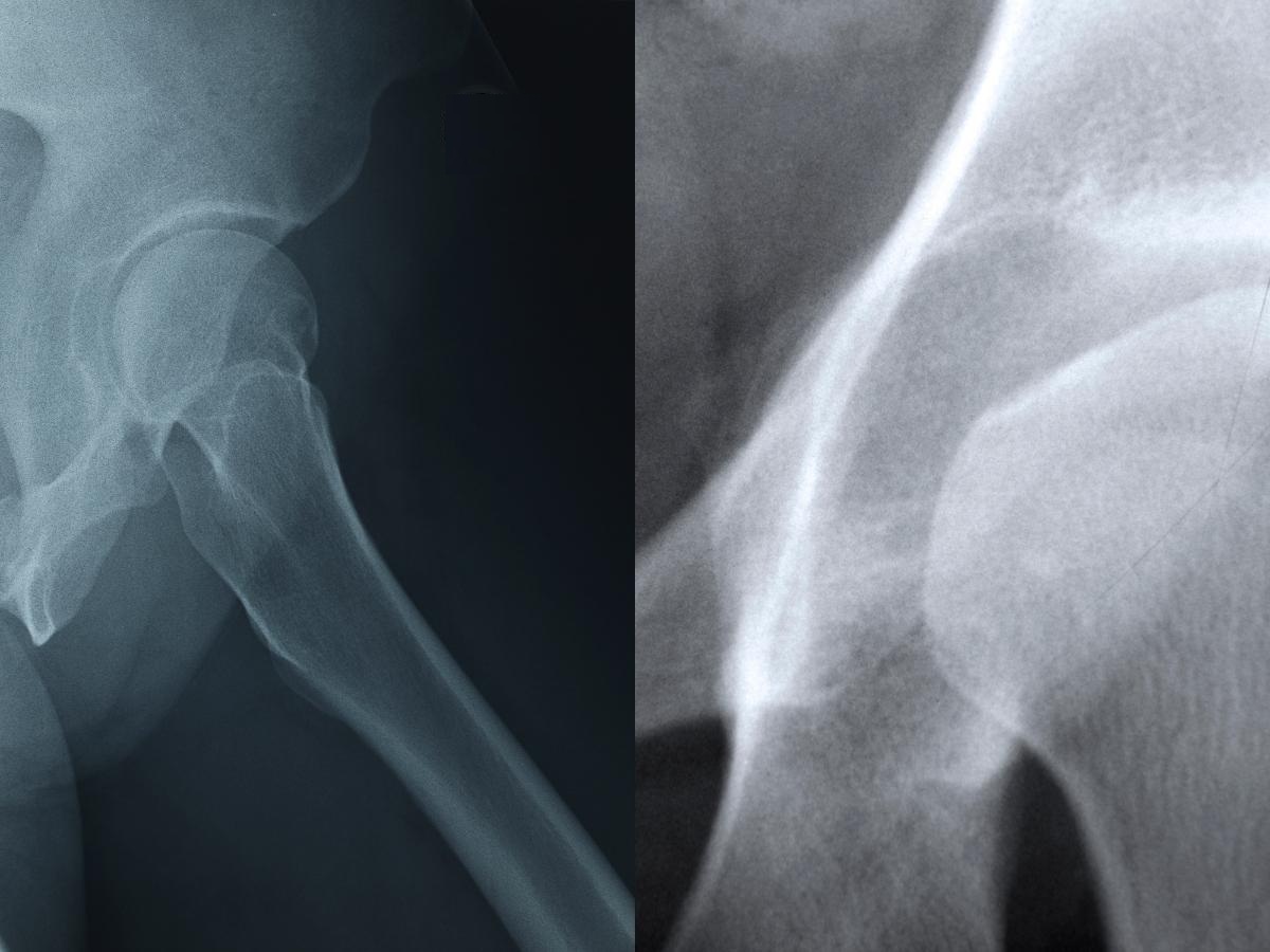 Why Do Your Hips Hurt During Menopause? I Dr. Pamela Mehta