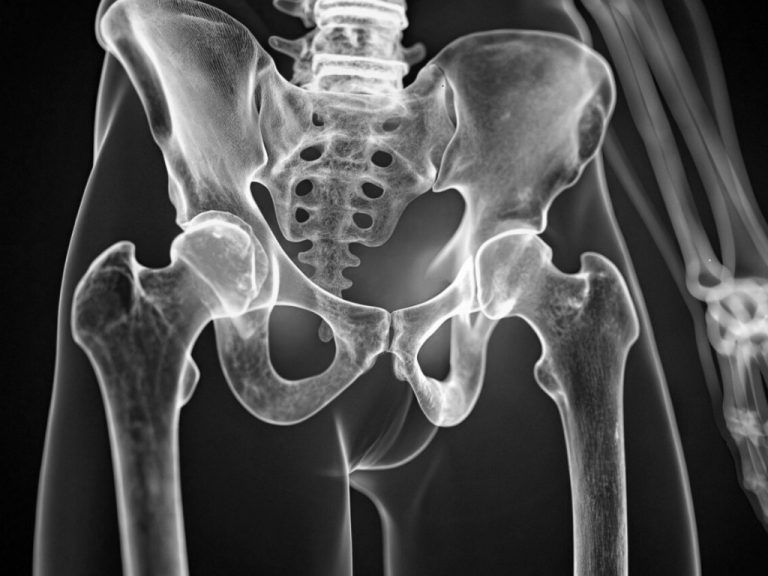 Hip Pain Treatment, Los Gatos & San Jose | Dr. Pamela Mehta